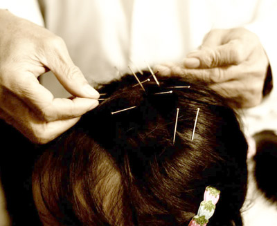 Scalp Acupuncture for Neurological Disorders